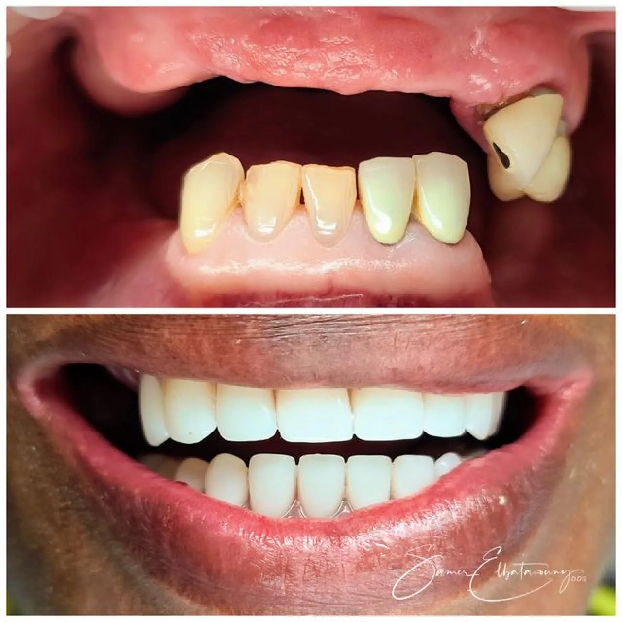 Dental Implants Chicago, IL | Replace Missing Teeth | City Edge Dental